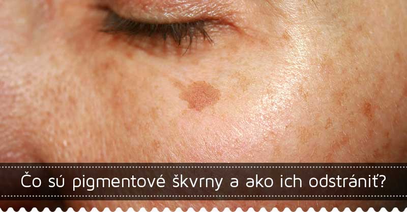 Čo sú pigmentové škvrny a ako ich odstrániť? | BIOnatural